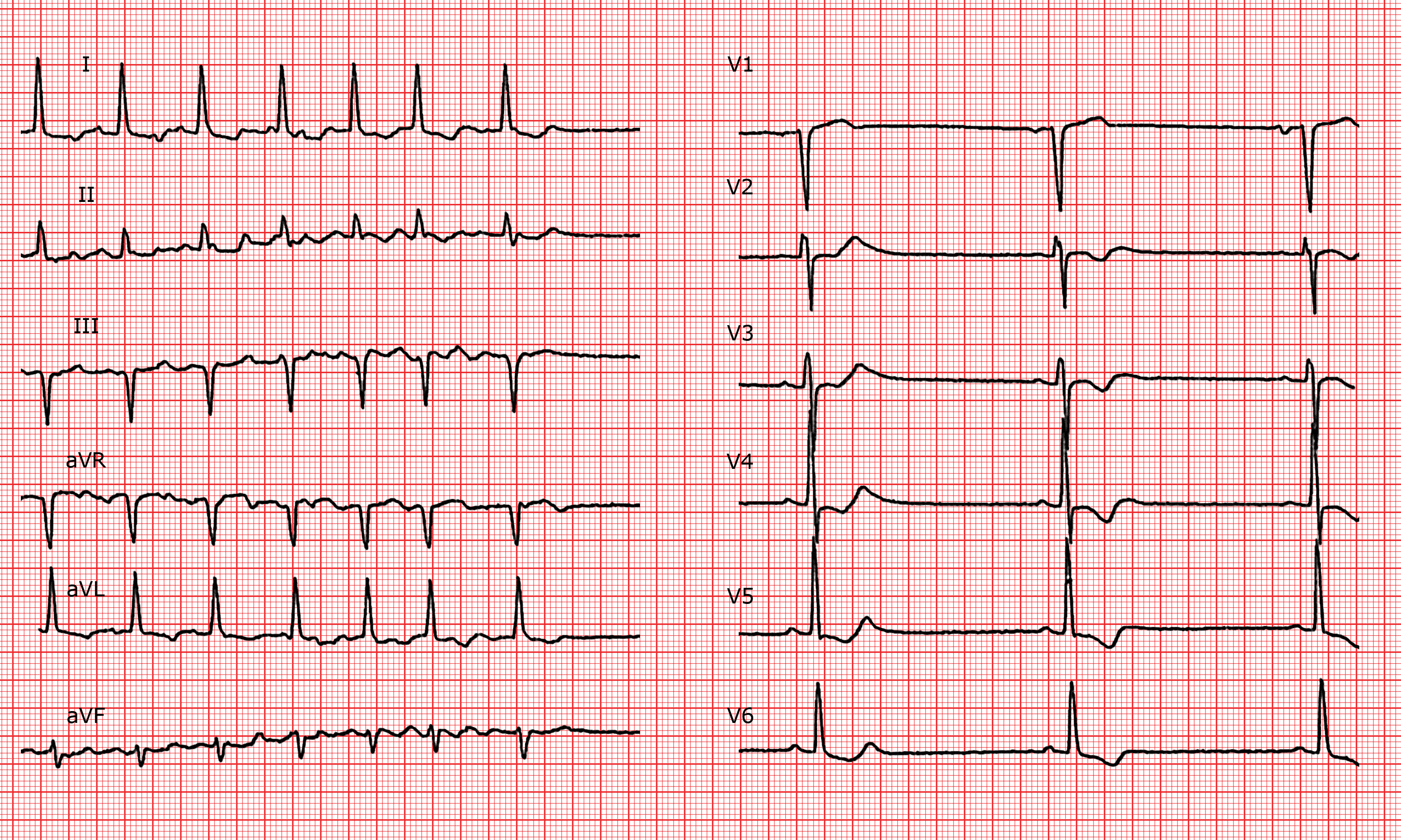 Cardio FR Tachycardia bradycardia Syndrome Cardio FR Tachycardia bradycardia Syndrome