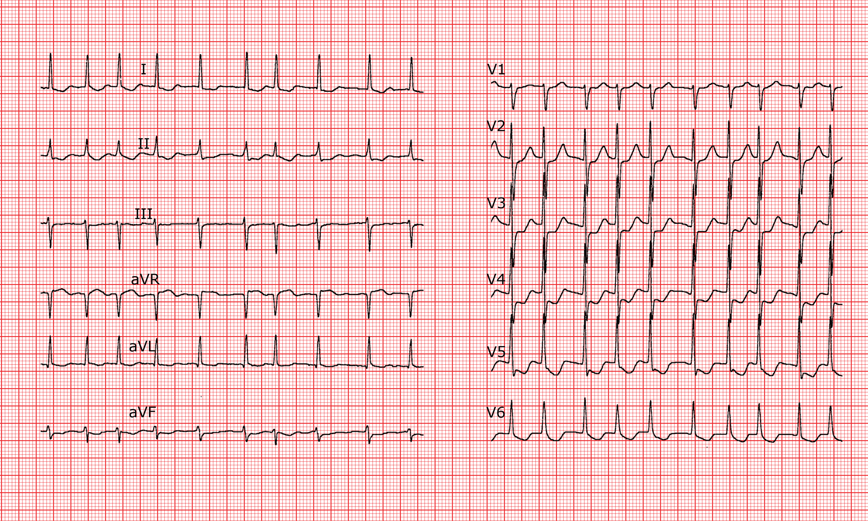 Cardio FR Atrial Fibrillation With Rapid Ventricular Response Cardio FR Atrial Fibrillation With Rapid Ventricular Response